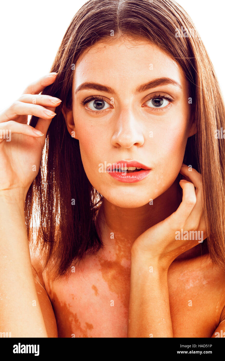 beautiful young brunette woman with vitiligo disease close up isolated ...