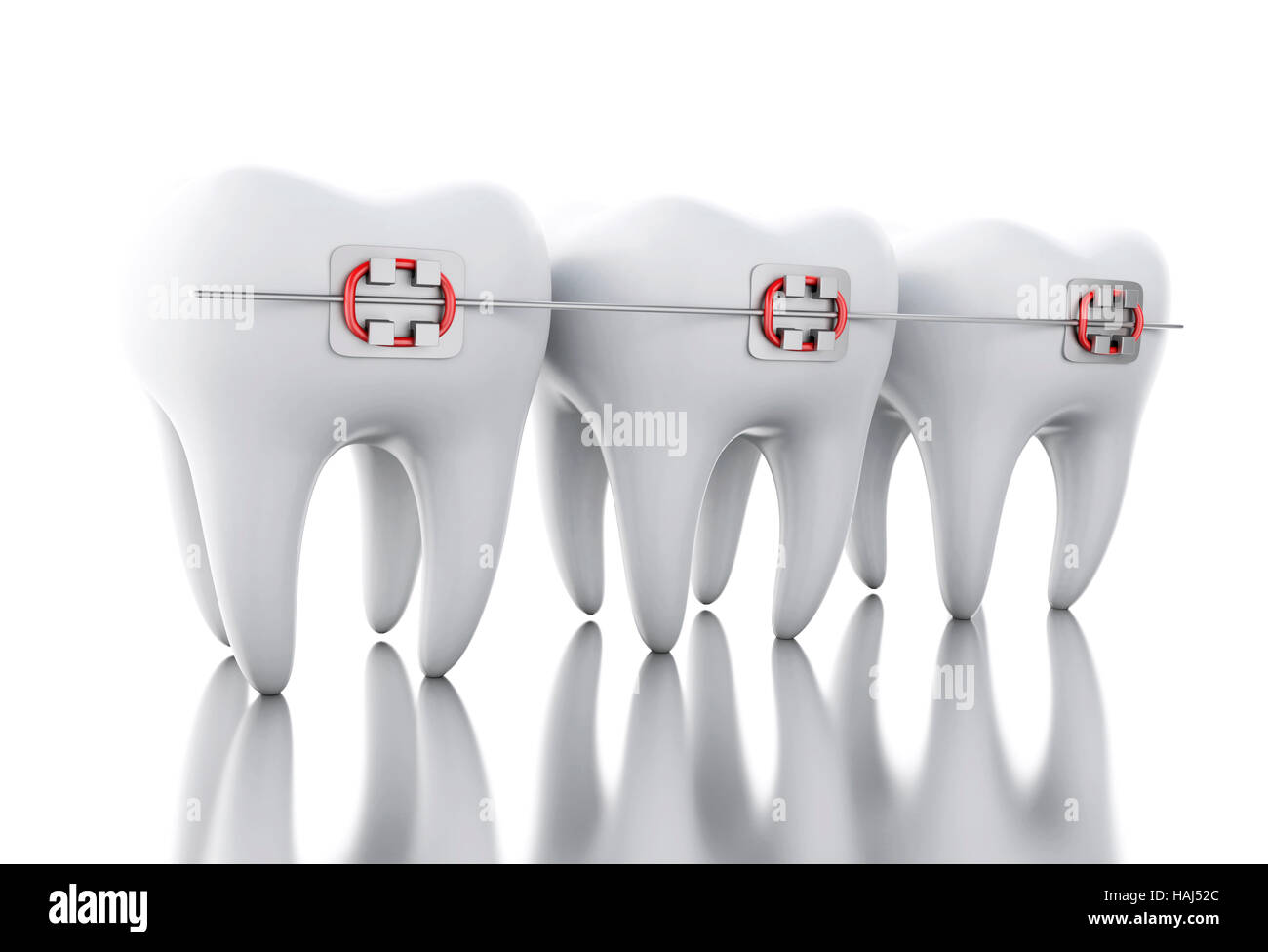 3D Illustration. Tooth with braces. Dental care concept. Isolated white ...