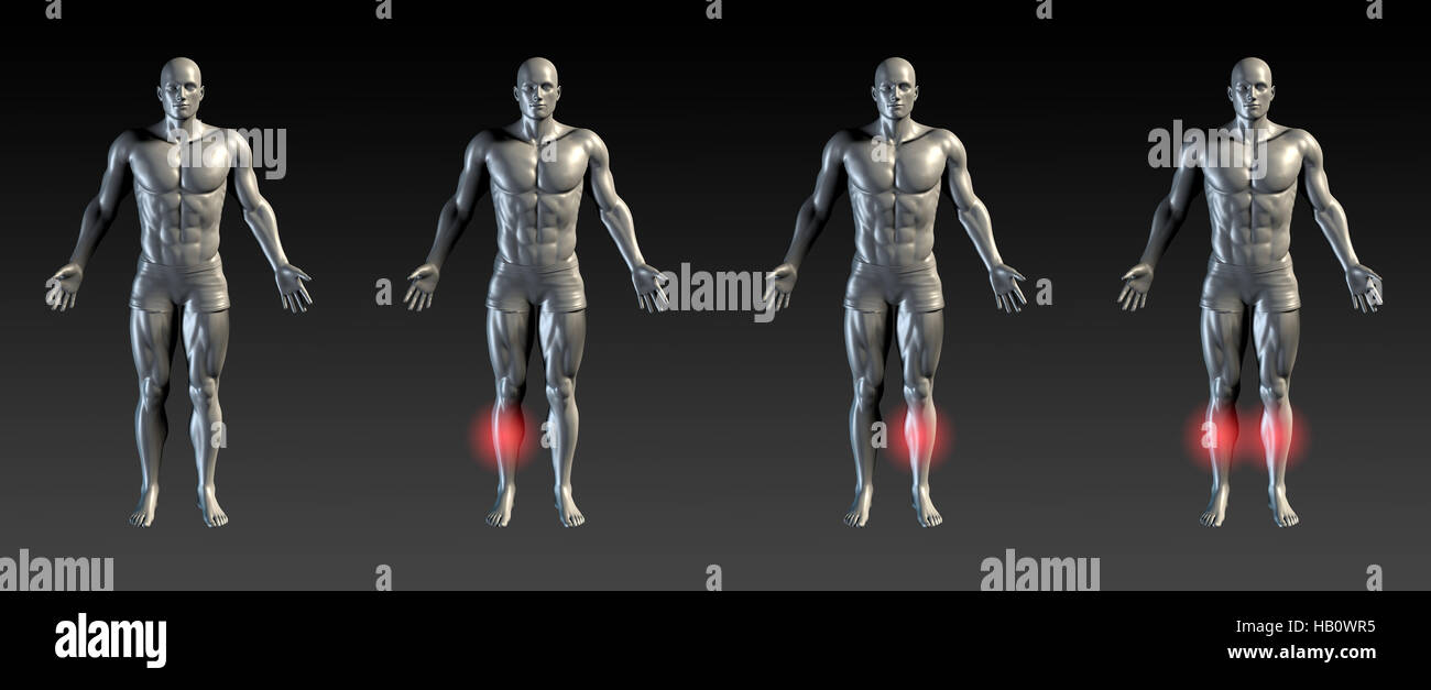 Shin splints hi-res stock photography and images - Alamy