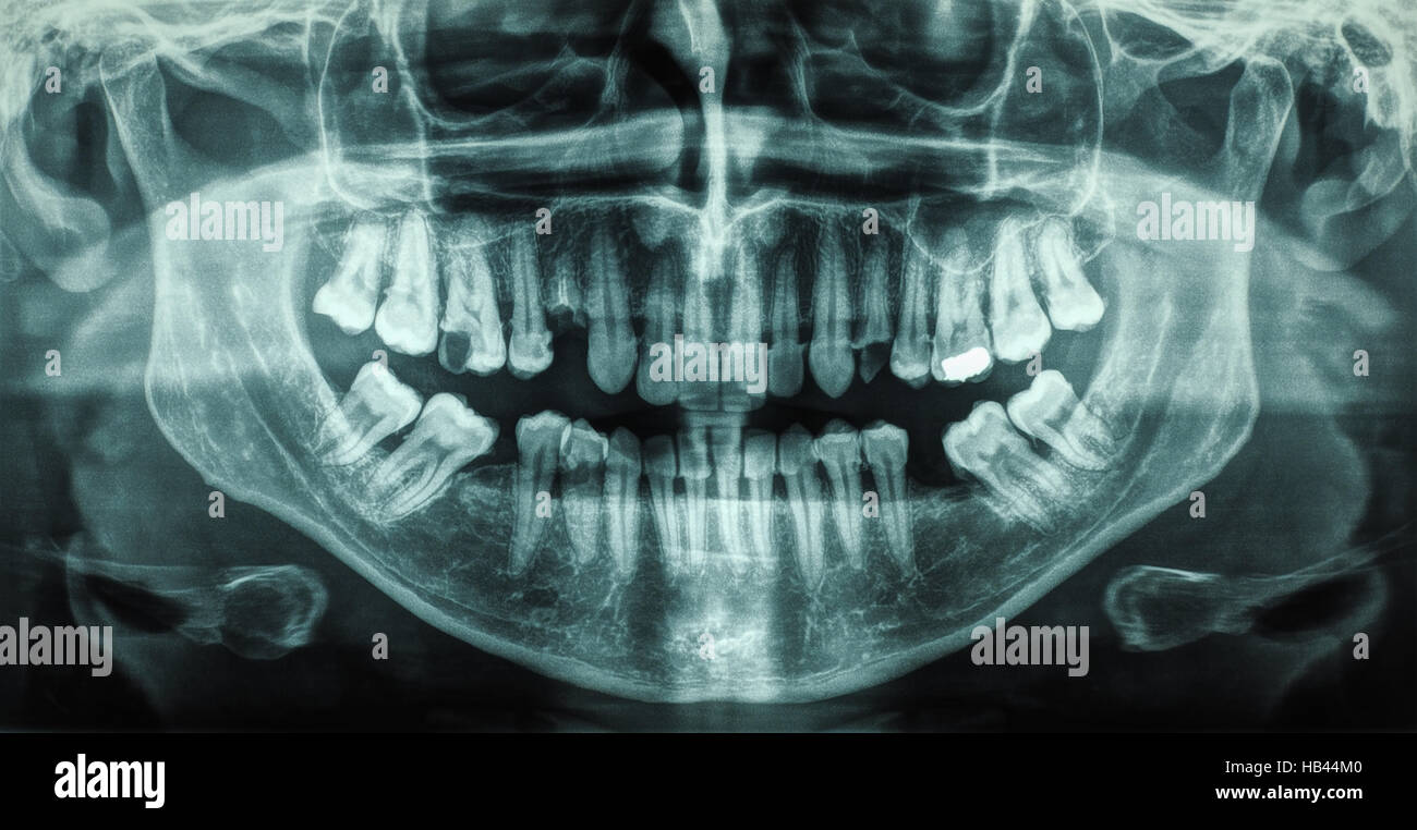 Human teeth xray Stock Photo - Alamy