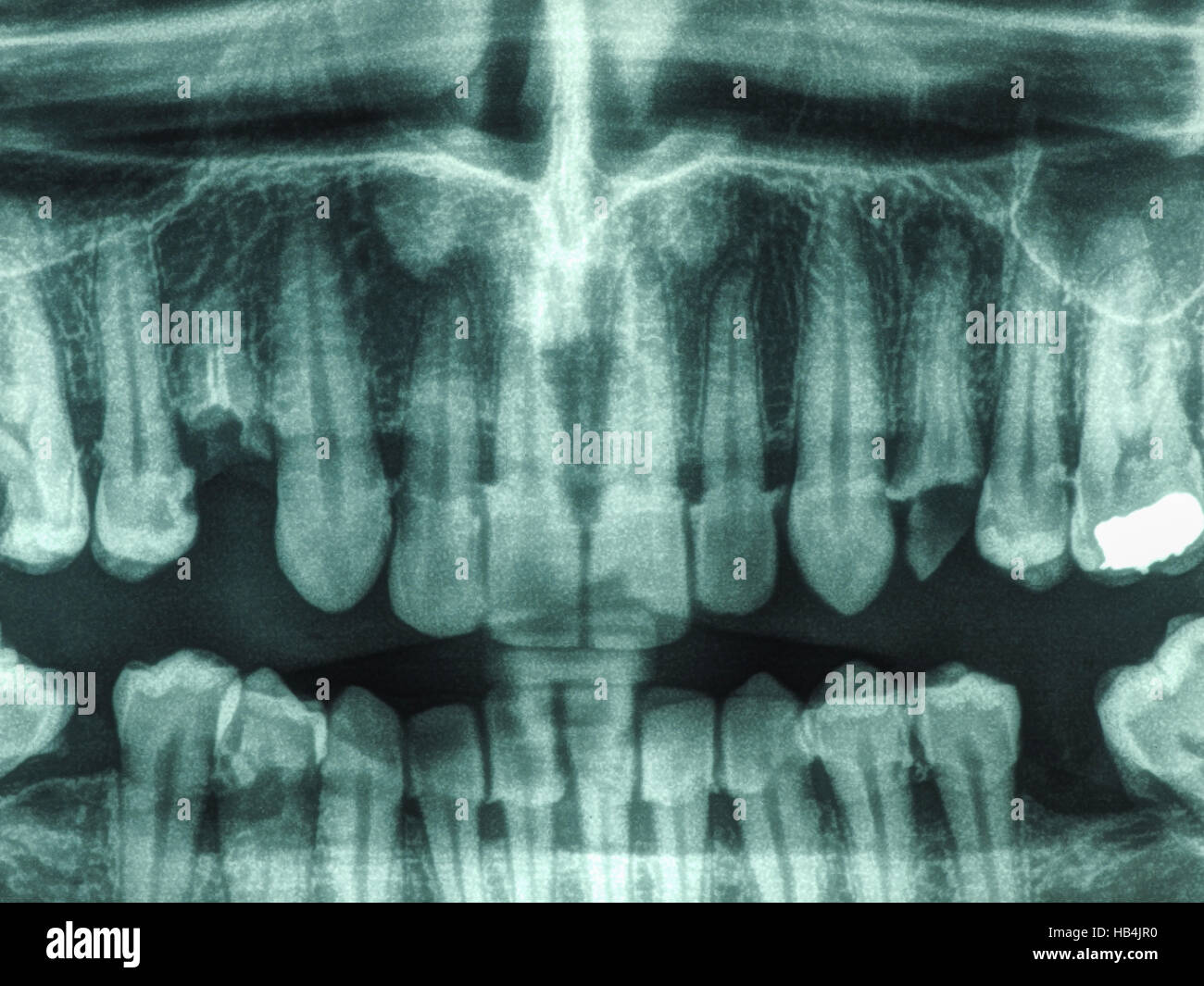 Human teeth xray Stock Photo - Alamy