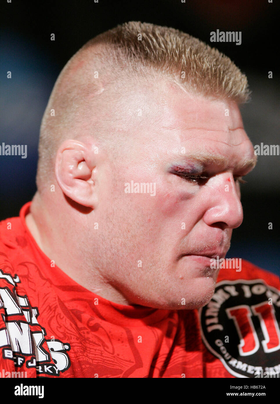Cauliflower Ear Brock Lesnar