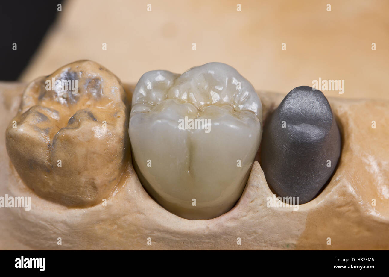 closeup for a ceramic dental crown for a molar teeth on a cast model ...