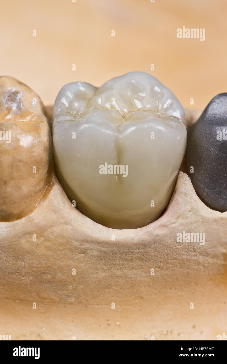 closeup for a ceramic dental crown for a molar teeth on a cast model ...