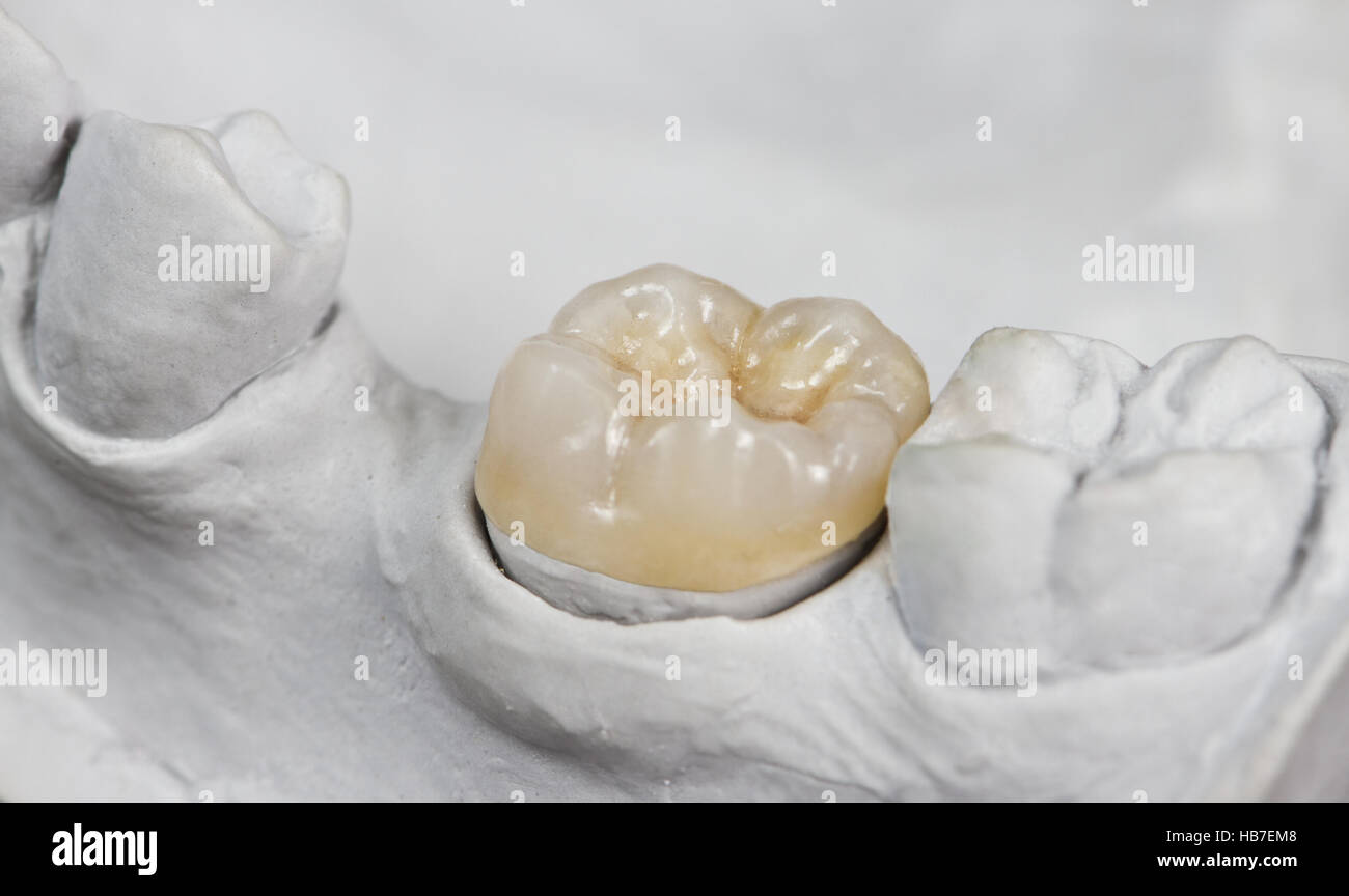 closeup for dental onlay on a molar tooth shown on a plaster model ...