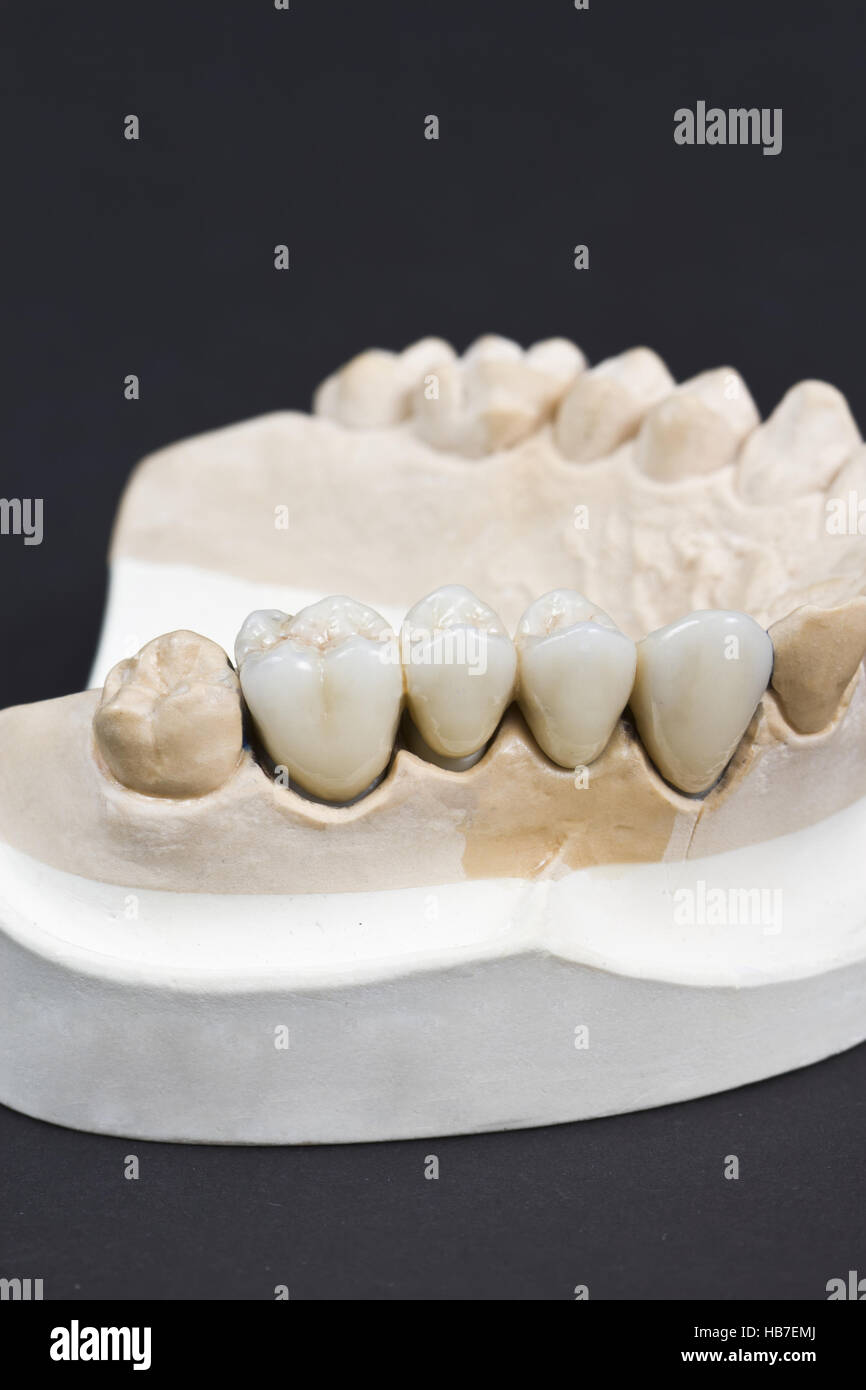 closeup for a dental ceramic bridge on a cast model Stock Photo - Alamy