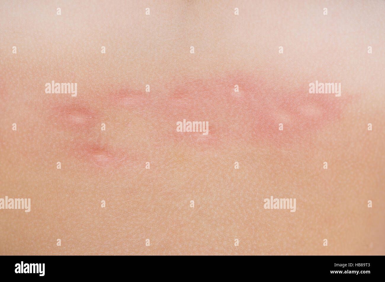 Bee sting skin hi-res stock photography and images - Alamy