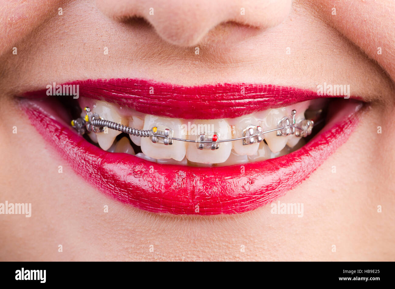 Woman with brackets isolated on white Stock Photo - Alamy