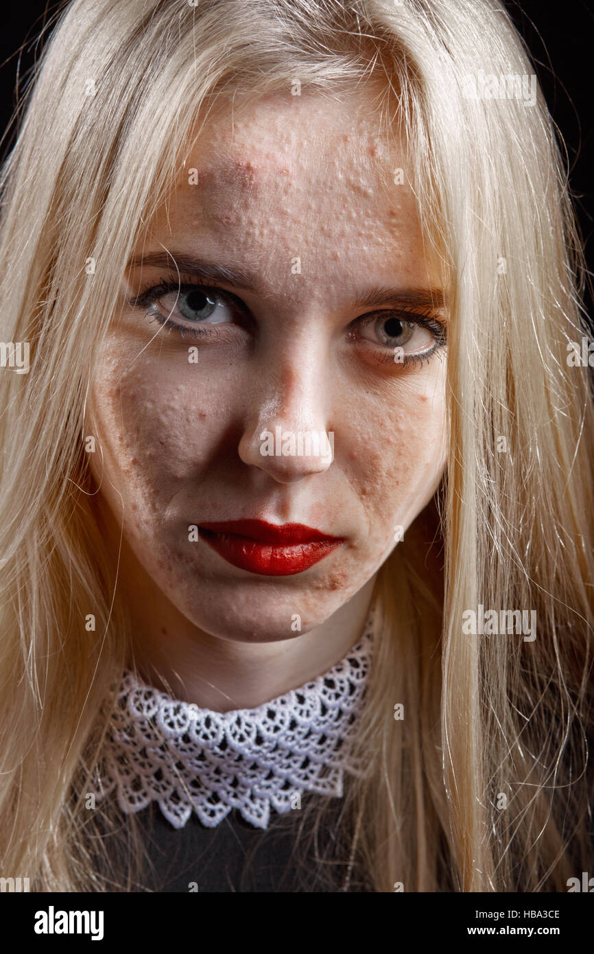 Teenage girl pimples hi-res stock photography and images - Alamy