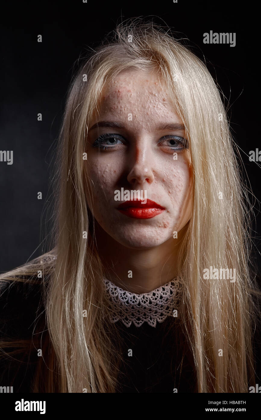 Teenage girl pimples hi-res stock photography and images - Alamy