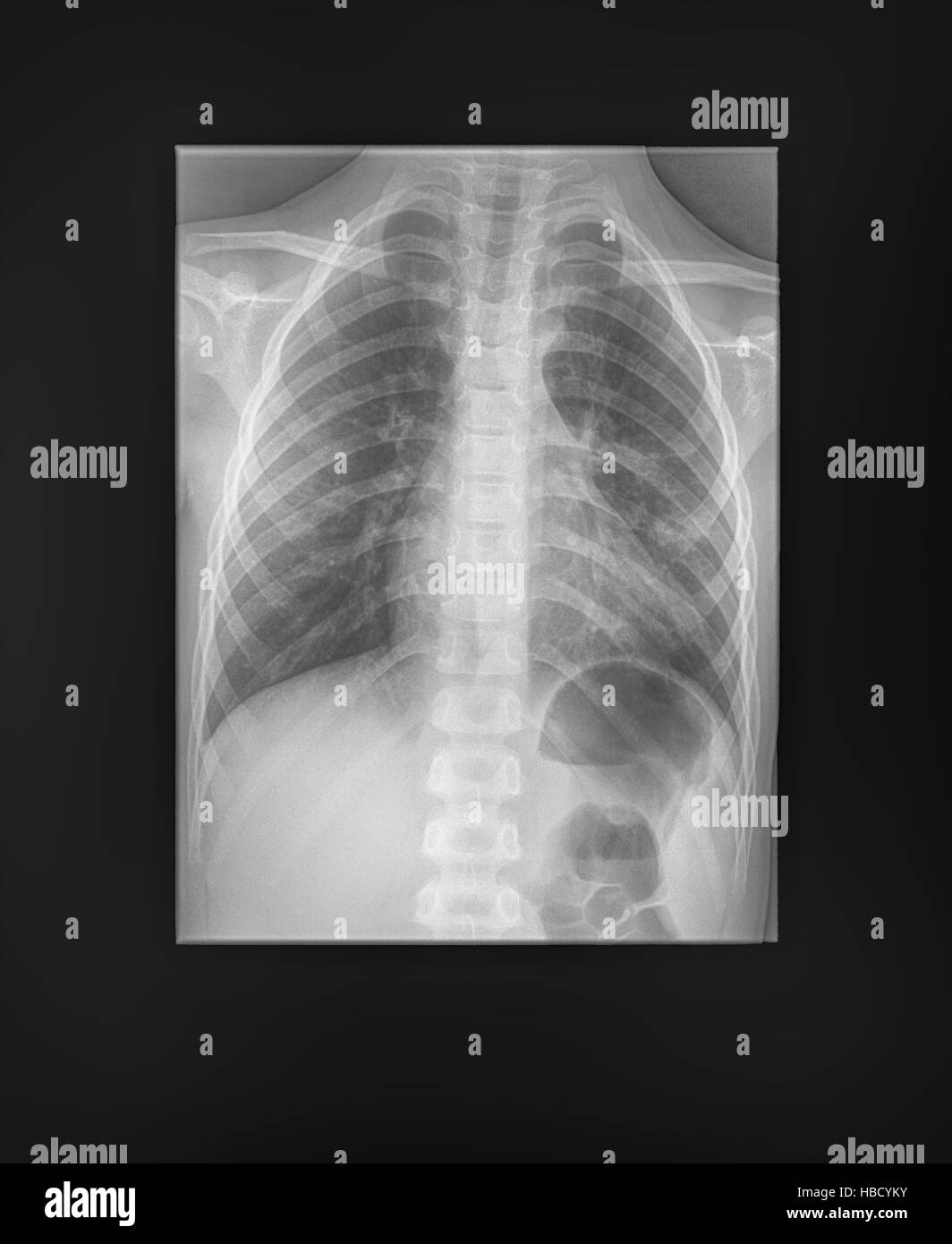 Chest X Ray Of Child Stock Photos & Chest X Ray Of Child Stock Images ...