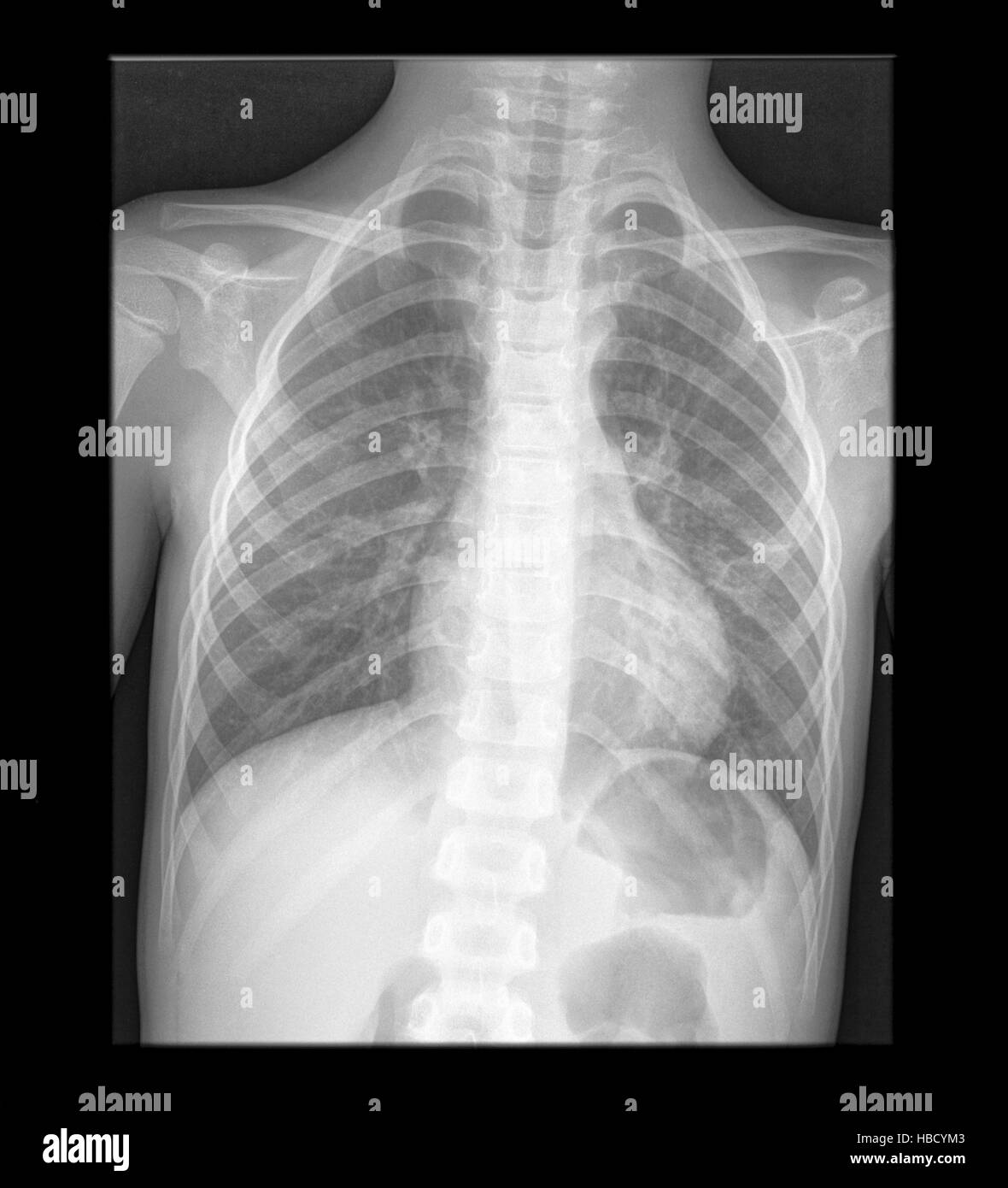 CXR X-RAY of five years old boy with left lobe pneumonia Stock Photo ...