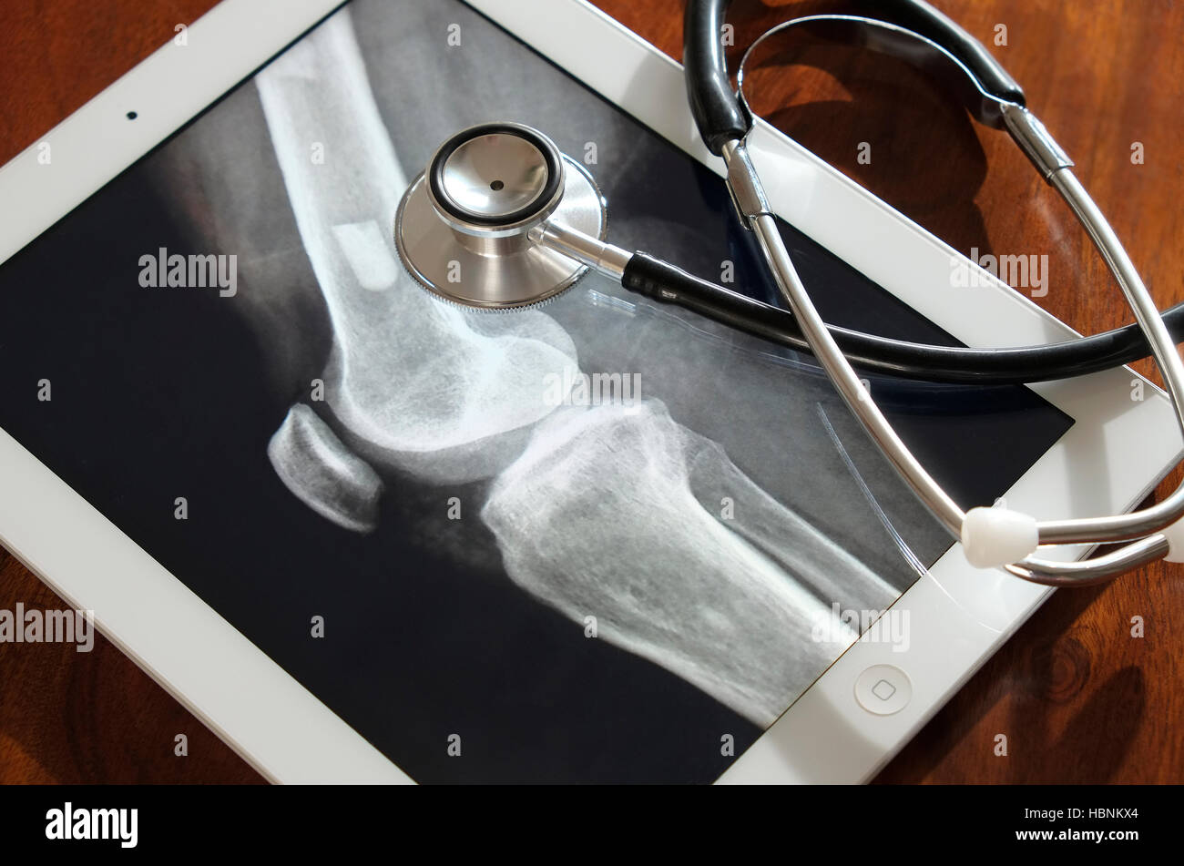 x-ray image on ipad tablet screen monitor of leg femur Stock Photo - Alamy