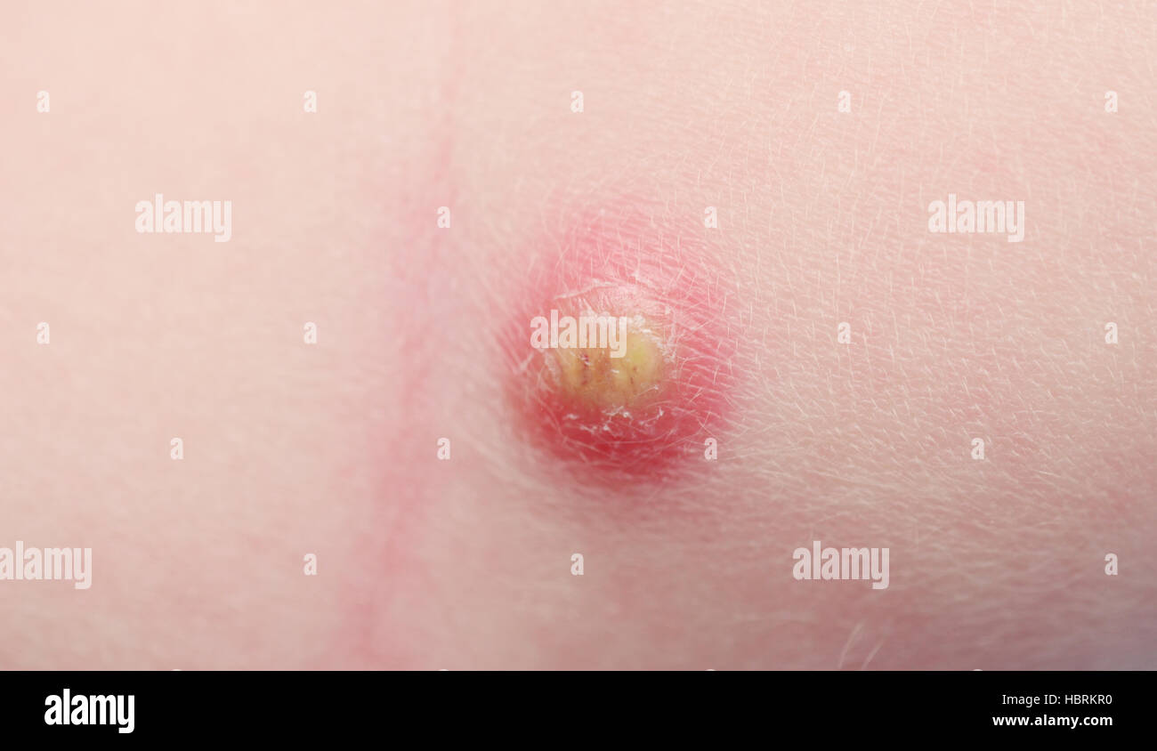 Pimple High Resolution Stock Photography and Images - Alamy