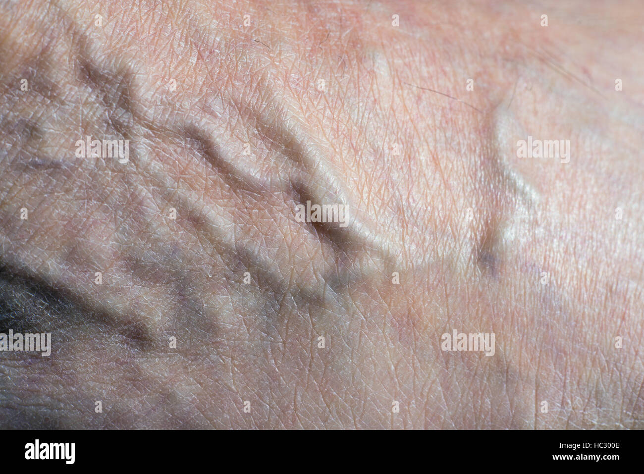 Varicose ulcer hi-res stock photography and images - Alamy