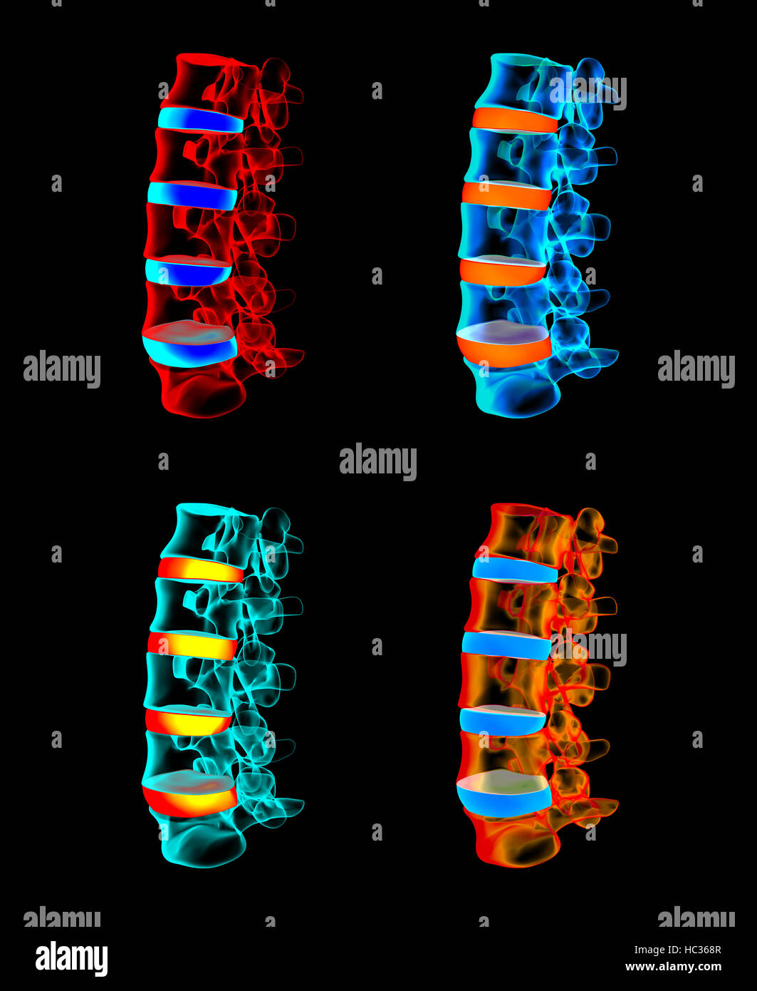 Spinal disc hi-res stock photography and images - Alamy
