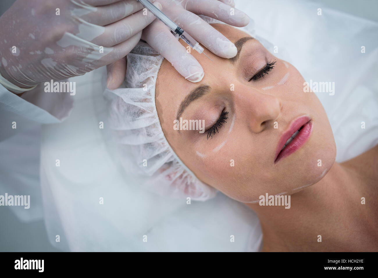 Woman with marked face receiving botox injection Stock Photo - Alamy