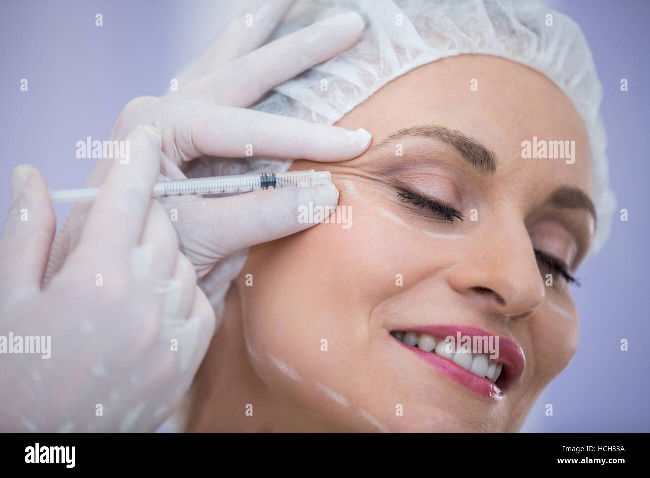 Woman with marked face receiving botox injection Stock Photo - Alamy