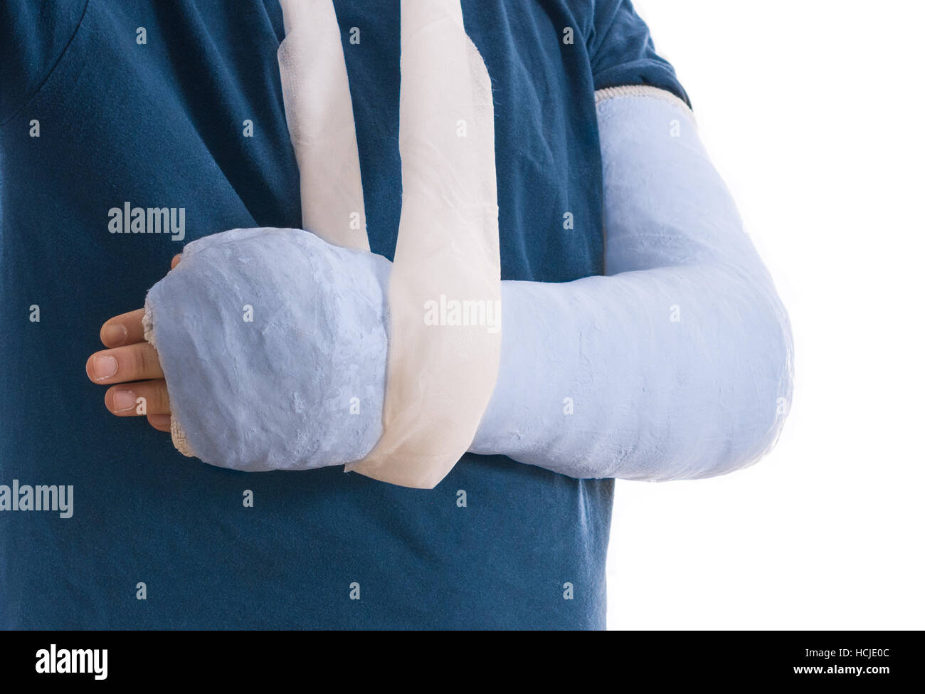 Arm cast - bright blue blue arm cast in a sling for a broken elbow, arm ...