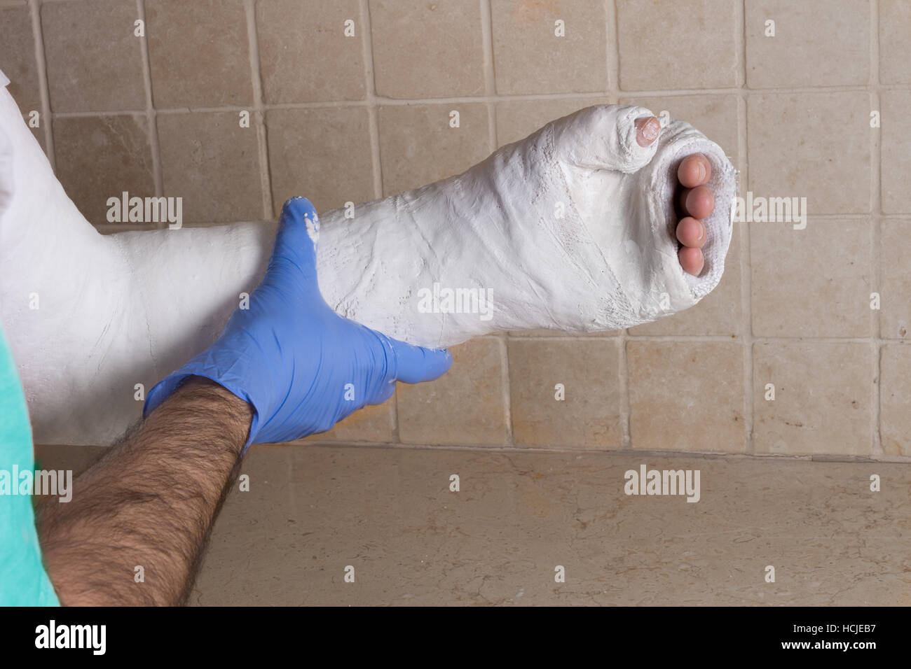Orthopedic technician putting on a fiberglass / plaster cast on a young ...