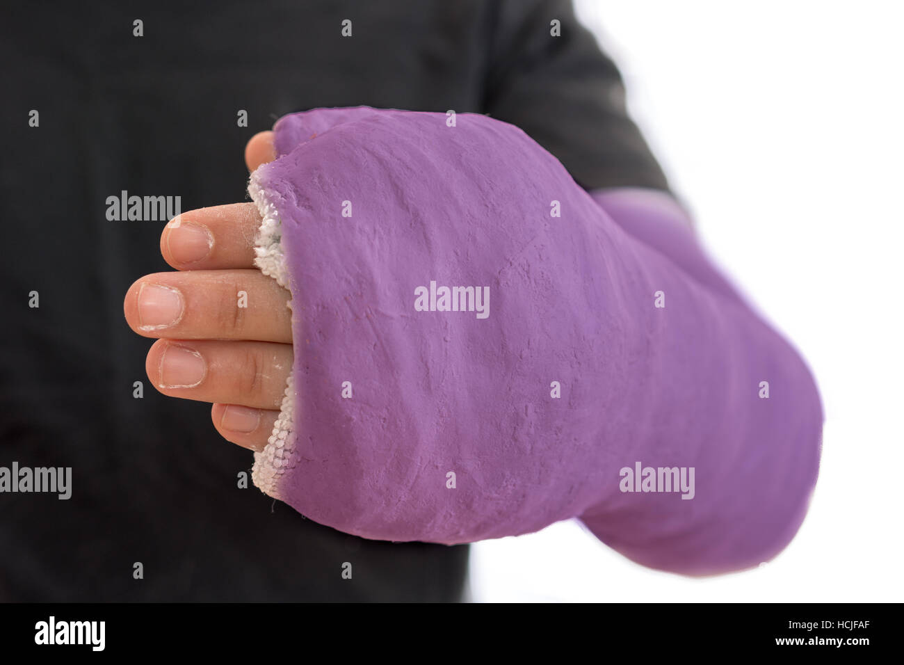 Close up of a purple long arm cast covering the thumb and a part of the ...