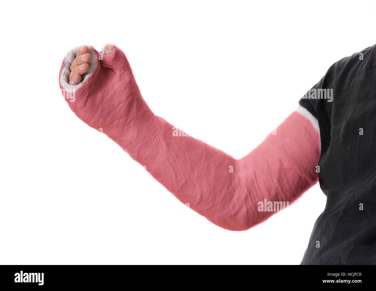Plaster After Wrist Fracture High Resolution Stock Photography and ...