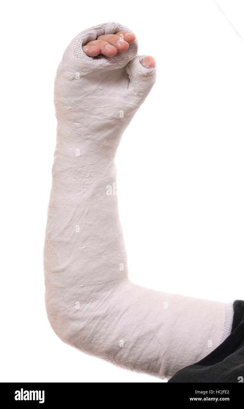 Plaster After Wrist Fracture Stock Photos & Plaster After Wrist ...