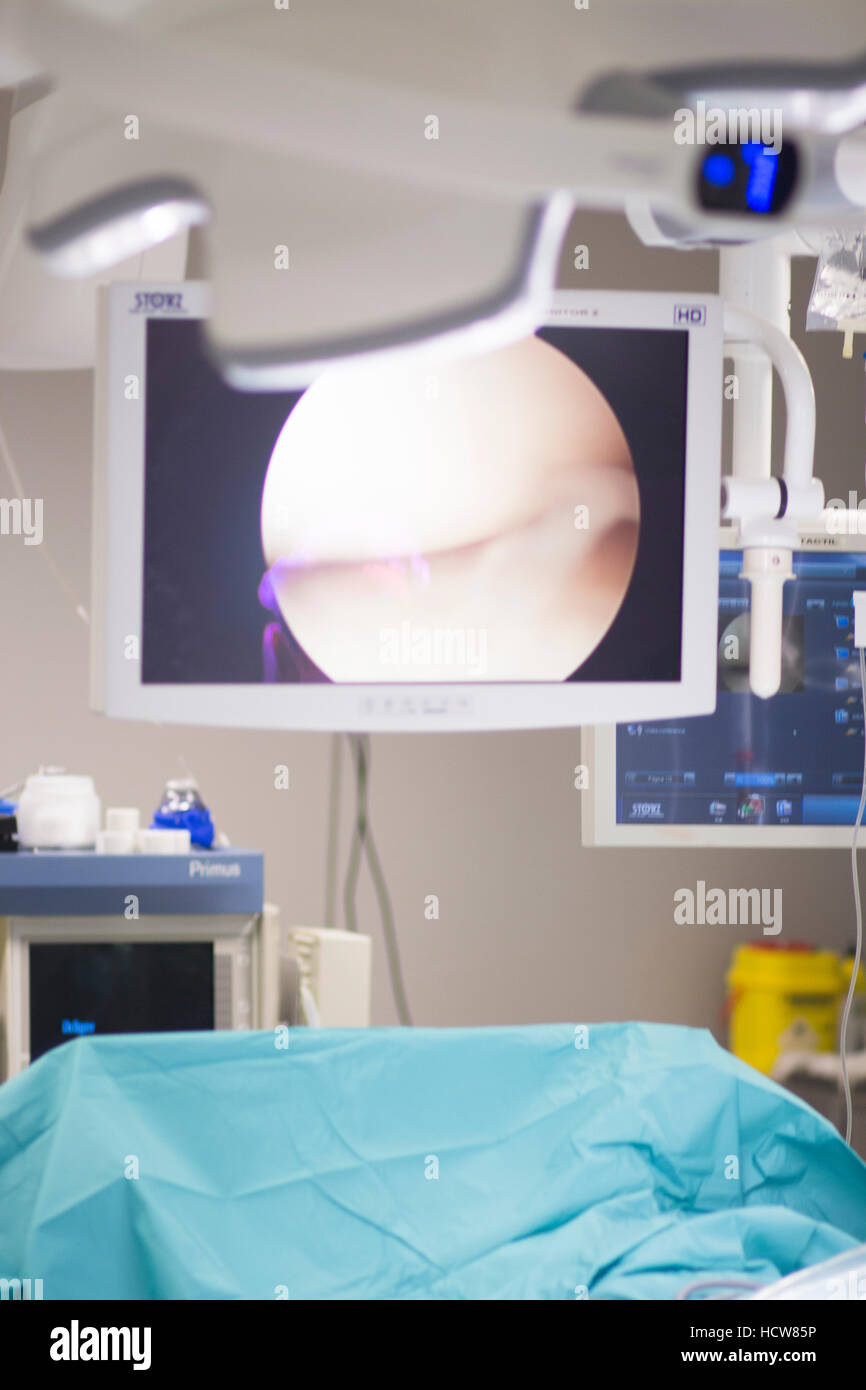 Arthroscopy surgery screen showing arthroscope camera picture in knee ...