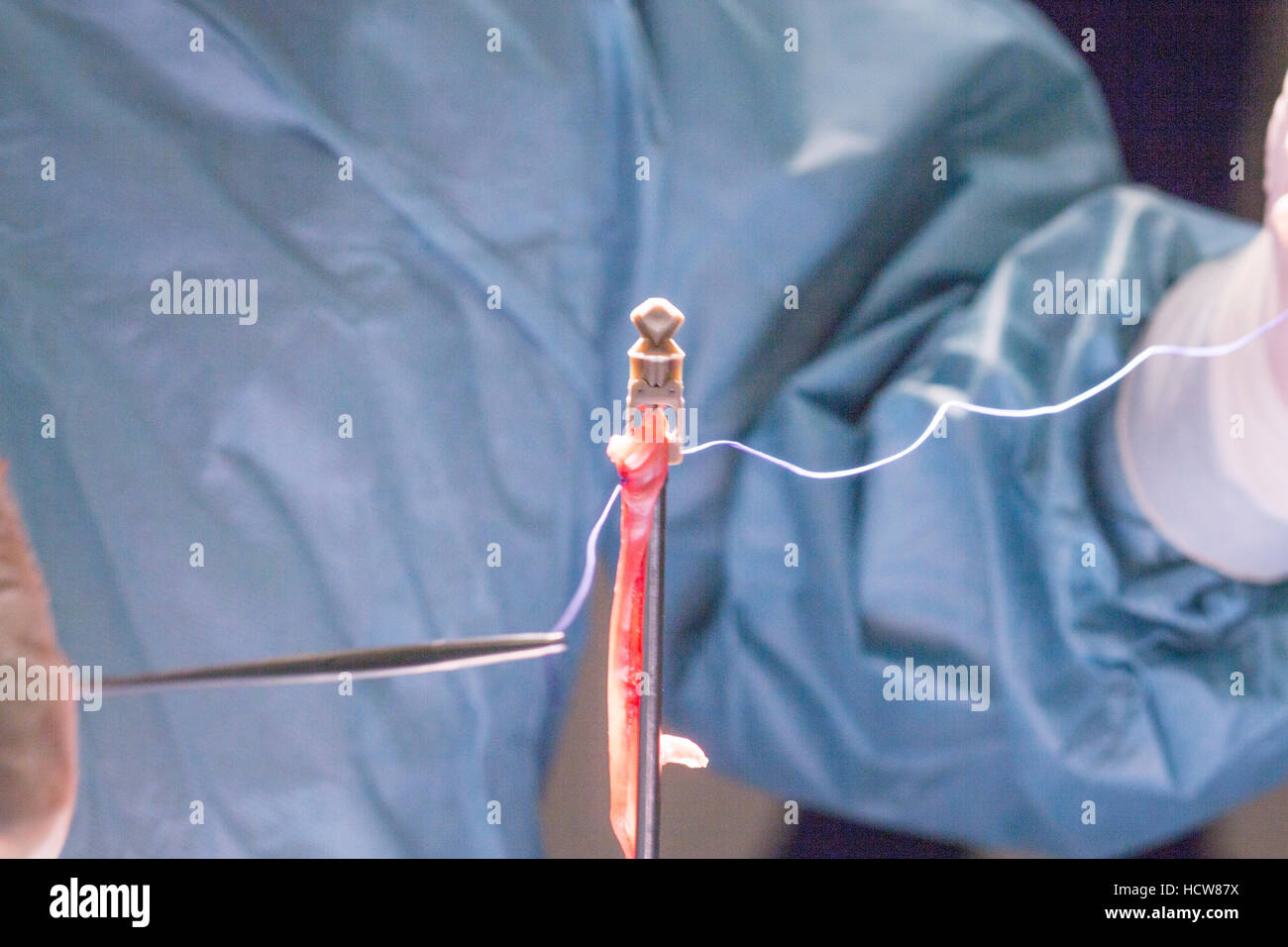 Knee tendon and ligament repair surgery in hospital operating theater ...