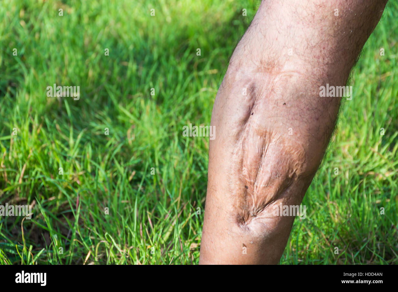 Old scar leg injury from hi-res stock photography and images - Alamy