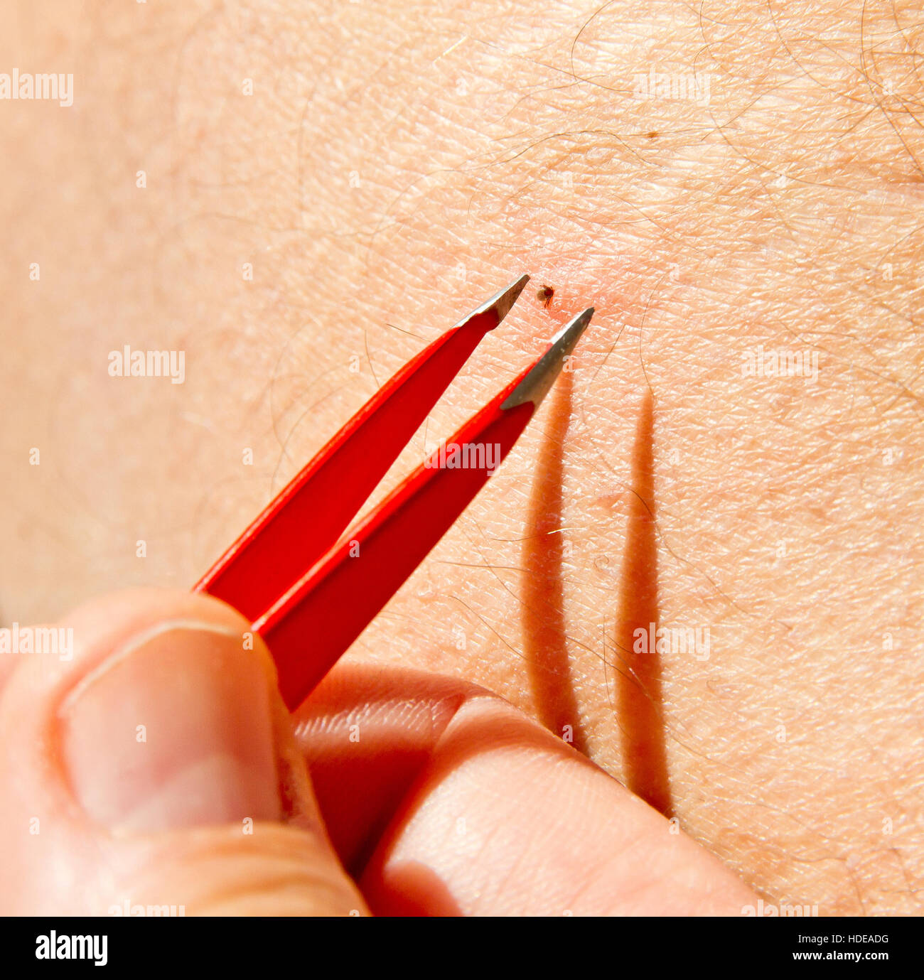 Removing a tick with tweezers from skin Stock Photo - Alamy