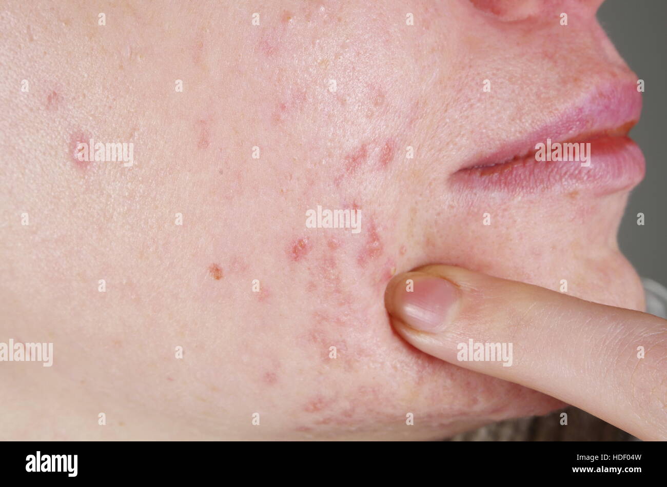 Acne hi-res stock photography and images - Alamy