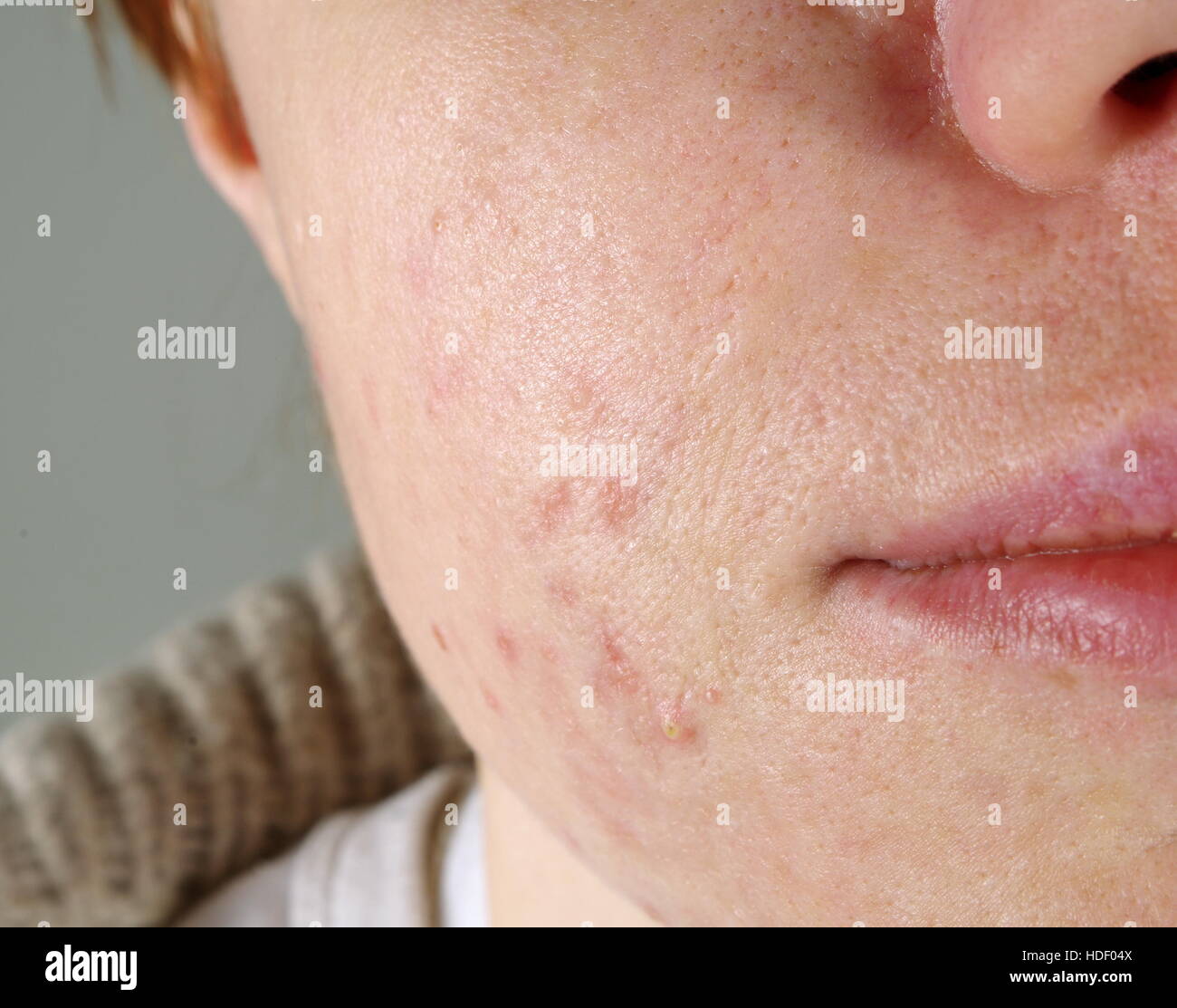 Acne problems hi-res stock photography and images - Alamy
