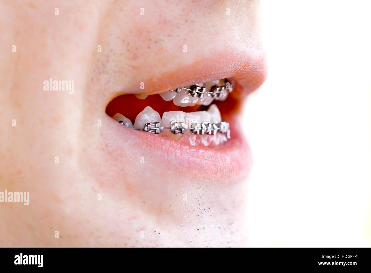 Teeth with braces Stock Photo - Alamy