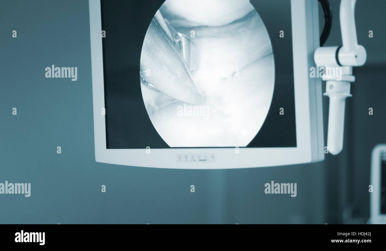 Arthroscopy surgery screen showing arthroscope camera picture in knee ...