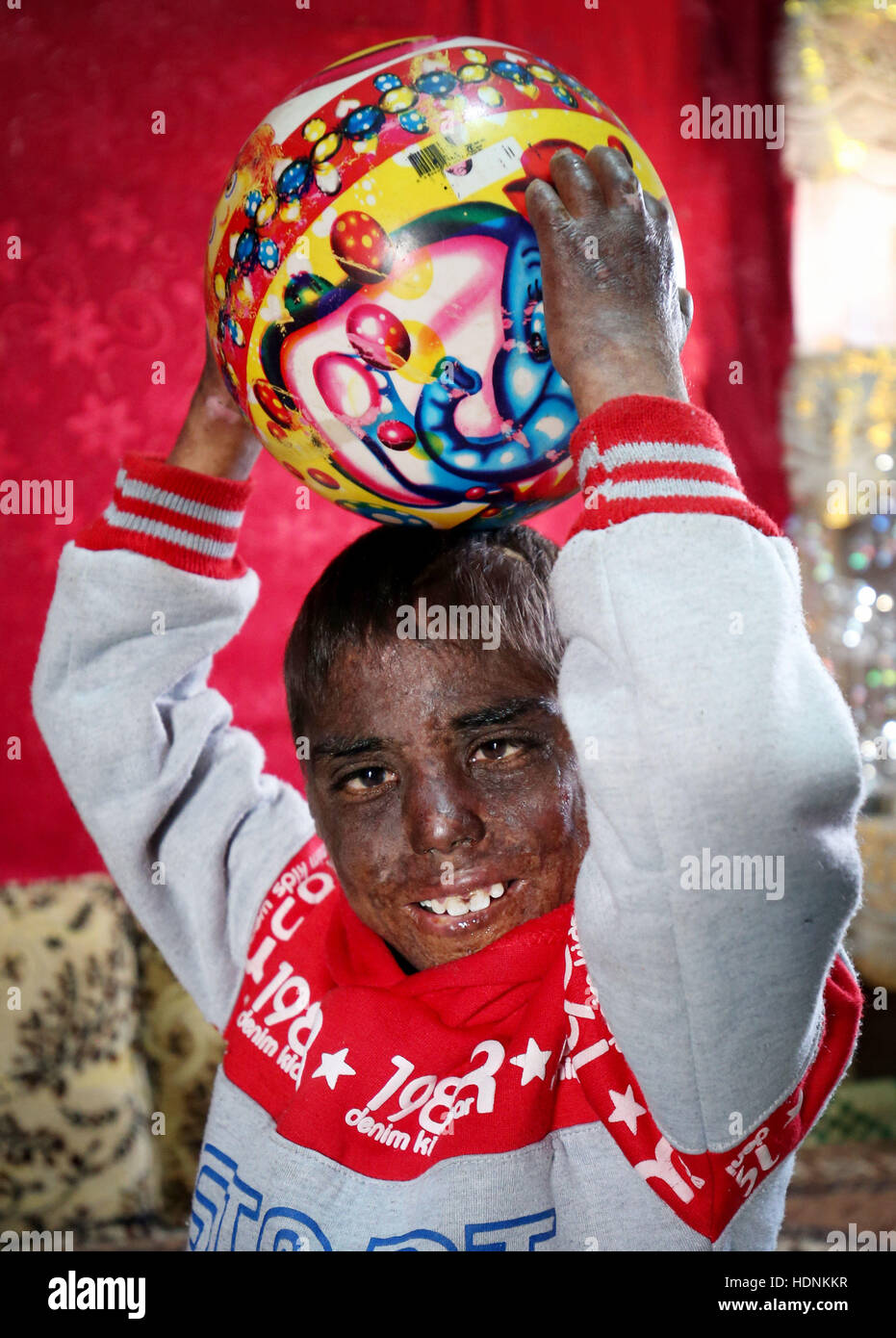 Syrian refugee Moussa, 12, who suffers from a rare skin condition, is ...