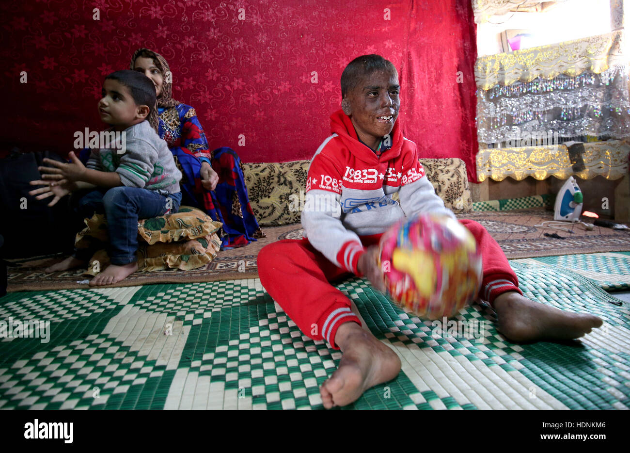 Syrian refugee Moussa, 12, who suffers from a rare skin condition, is ...
