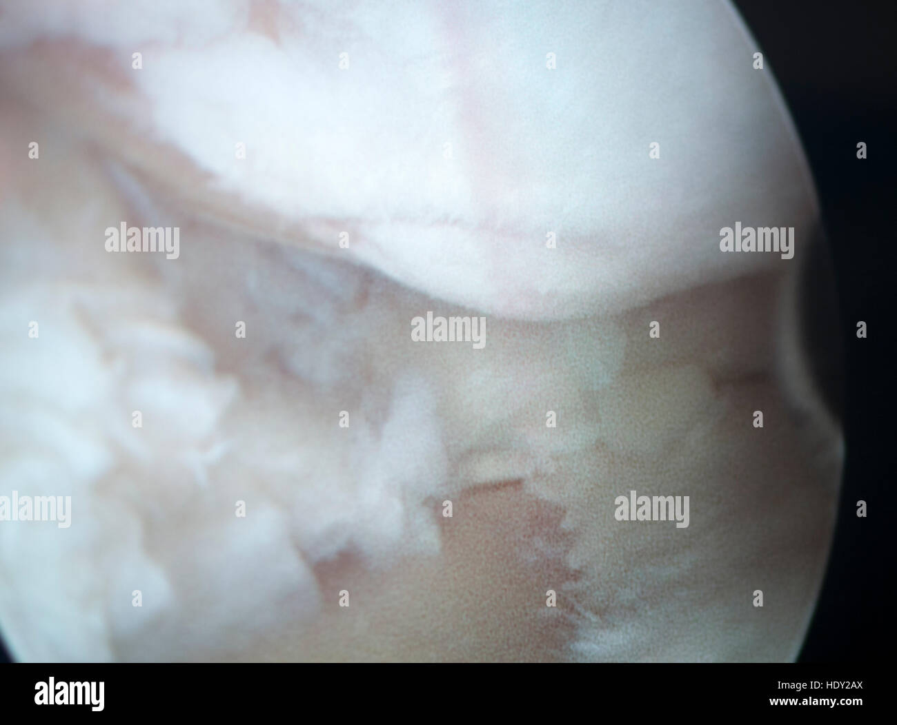 Arthroscopy surgery screen showing arthroscope camera picture in knee ...