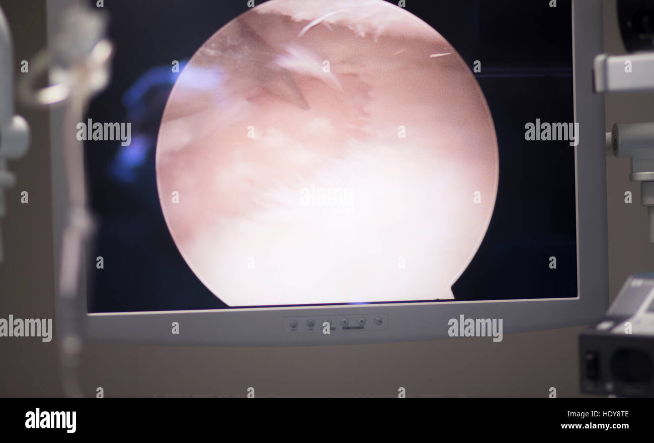 Arthroscopy surgery screen showing arthroscope camera picture in knee ...