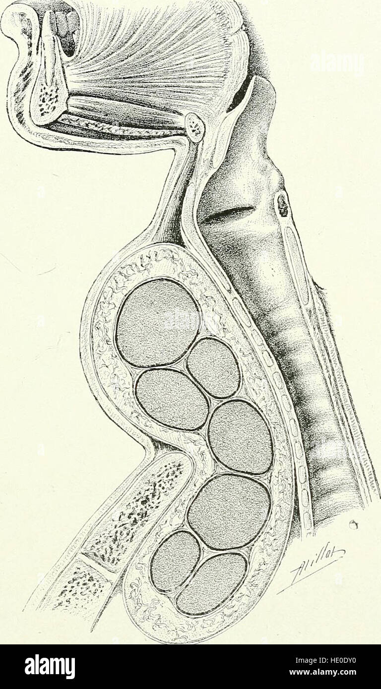 Operative technique hi-res stock photography and images - Alamy