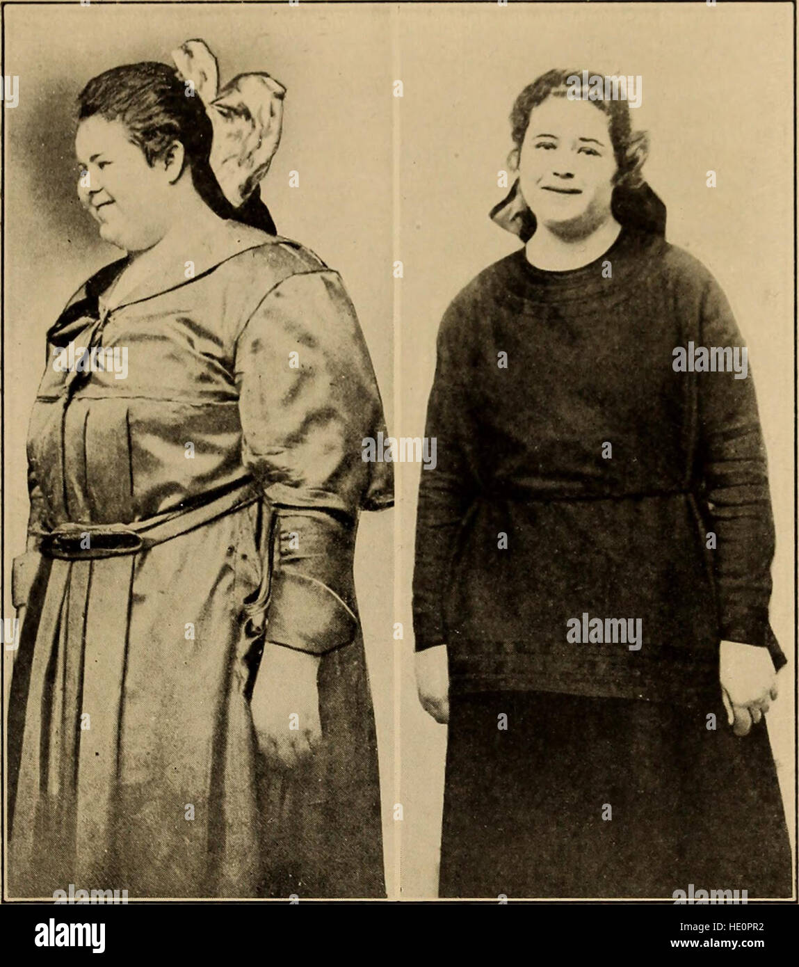 Nutrition and growth in children (1922 Stock Photo - Alamy