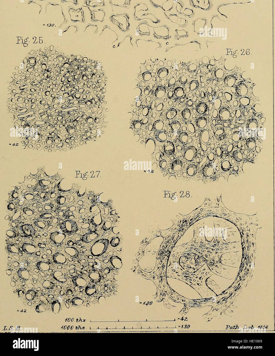 *Kidney Diseases, Urinary Deposits, and Calculous Disorders* (1870 ...