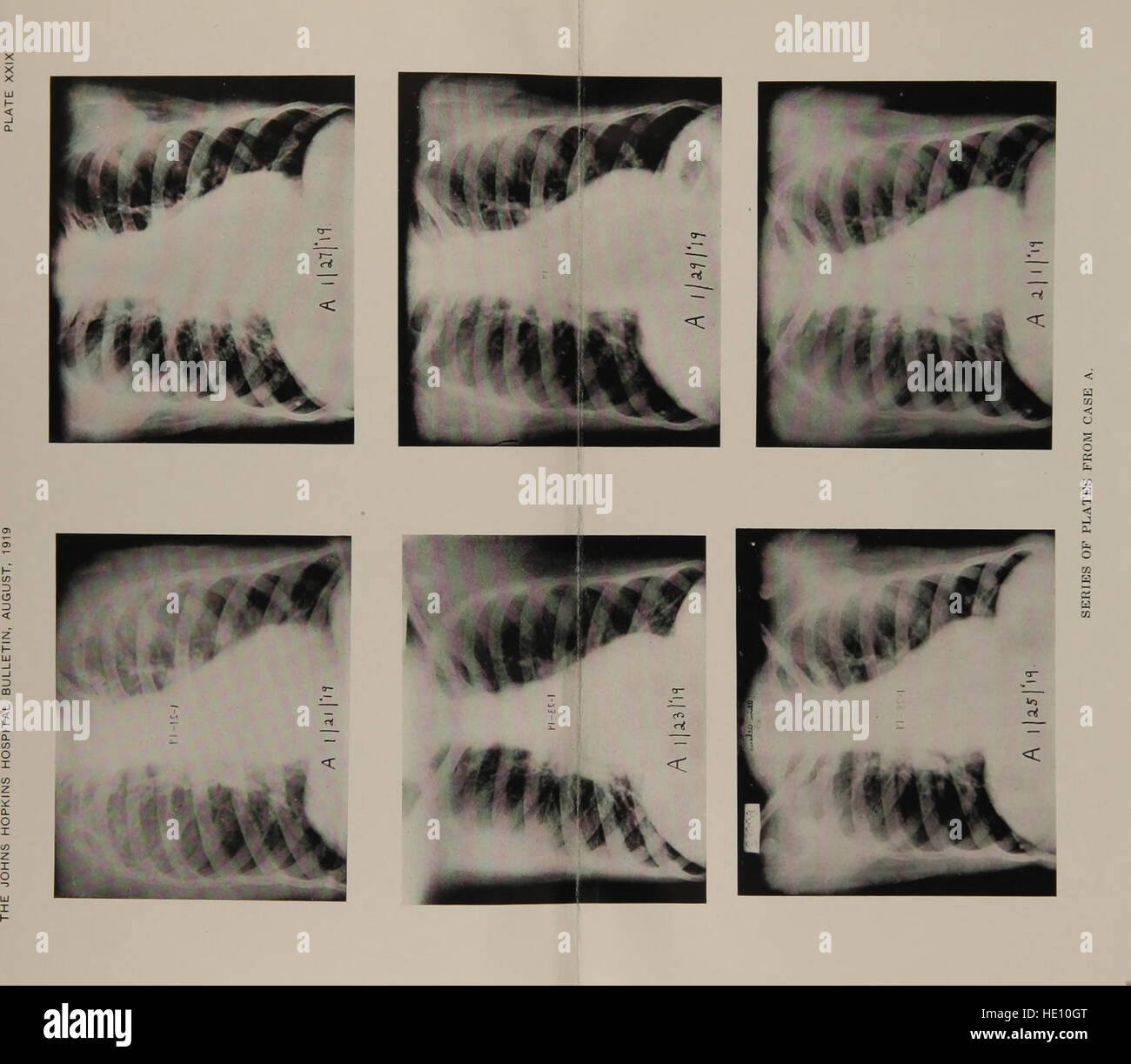 *The Correlation of X-Ray Findings and Physical Signs in the Chest in ...