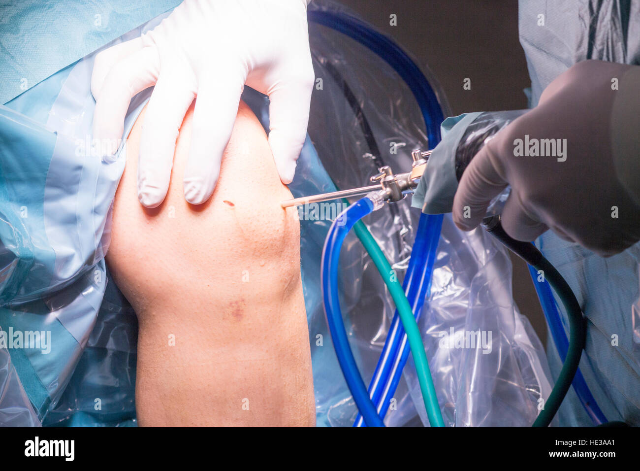 Surgical operation for knee arthroscopy micro surgery in hospital ...