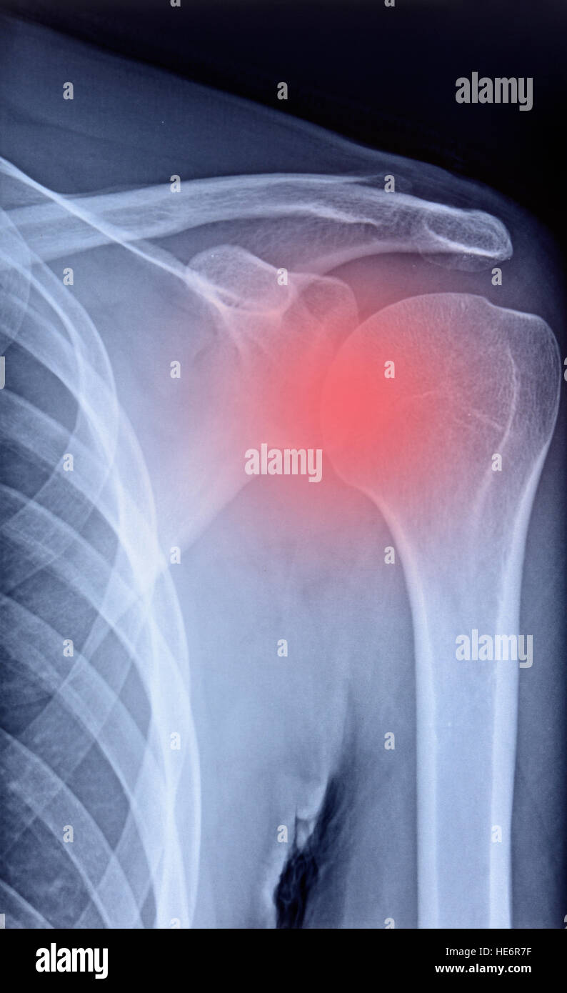 Shoulder xray hi-res stock photography and images - Alamy