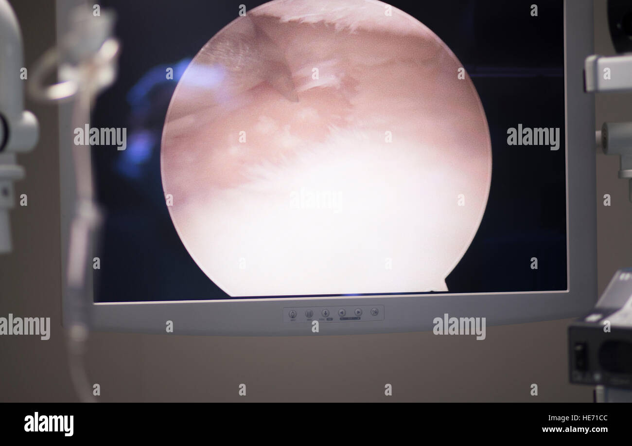 Arthroscopy surgery screen showing arthroscope camera picture in knee ...