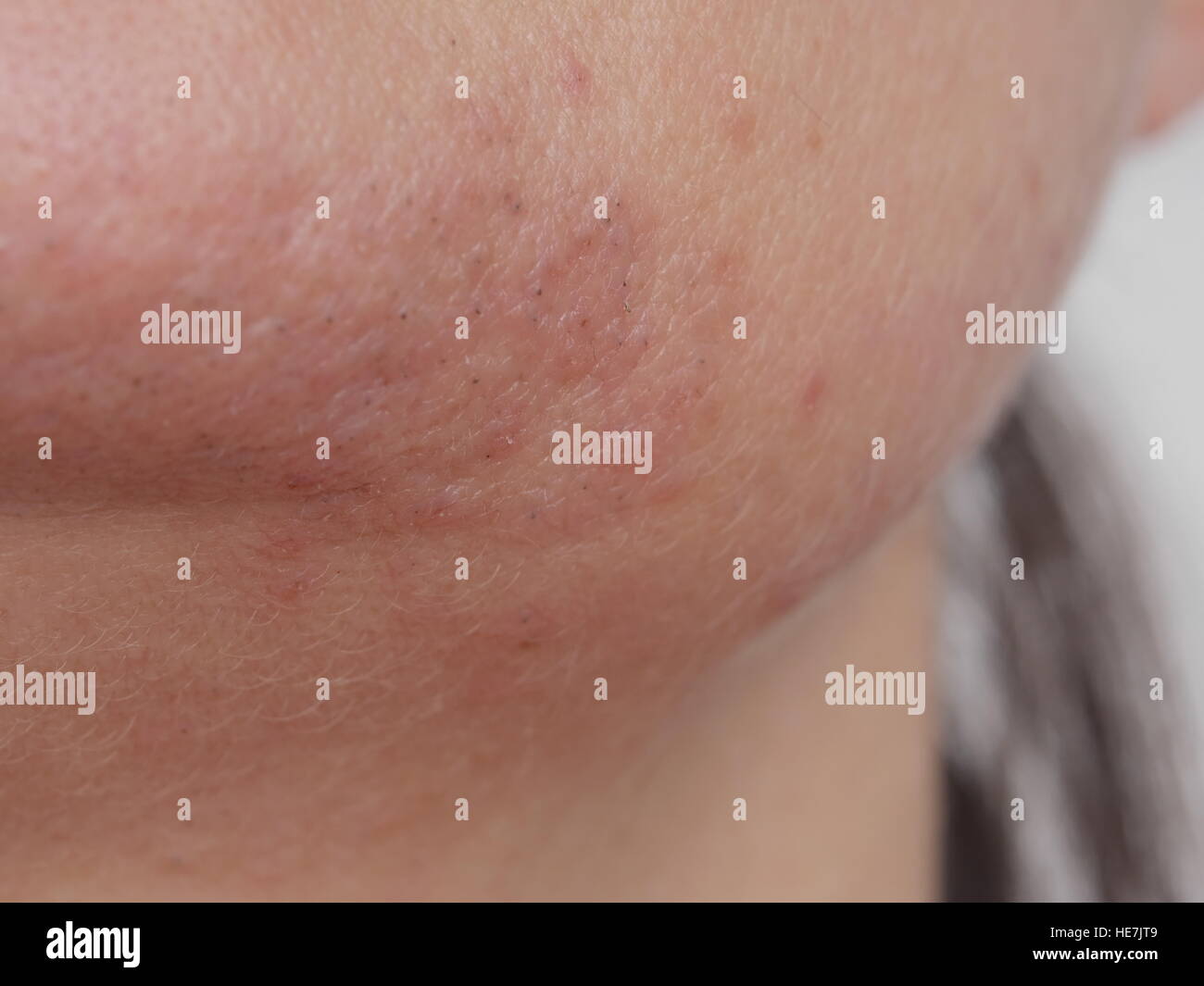 Allergic rash dermatitis skin texture hi-res stock photography and ...