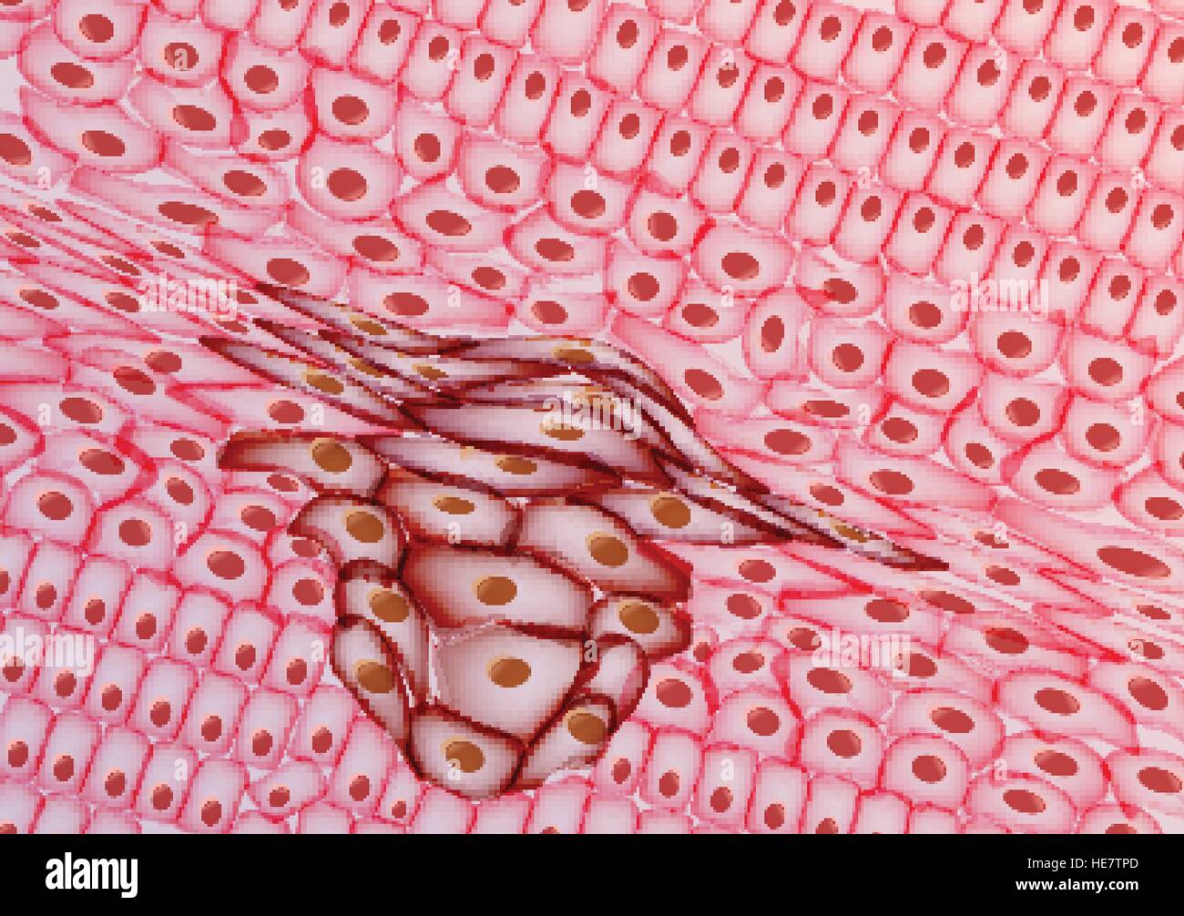 Epithelial tumor hi-res stock photography and images - Alamy