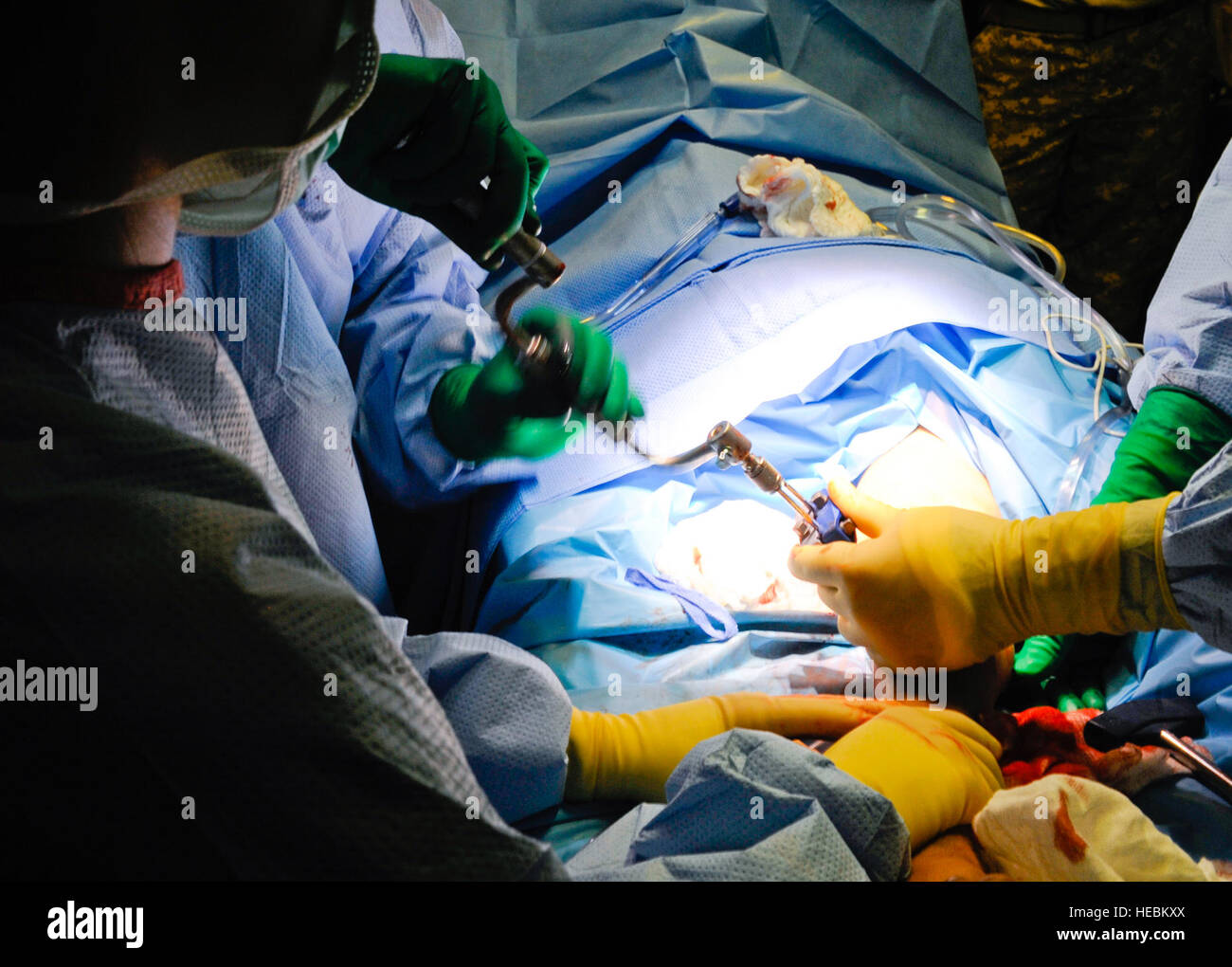 Members of the 541st Forward Surgical Team perform surgery on a five ...