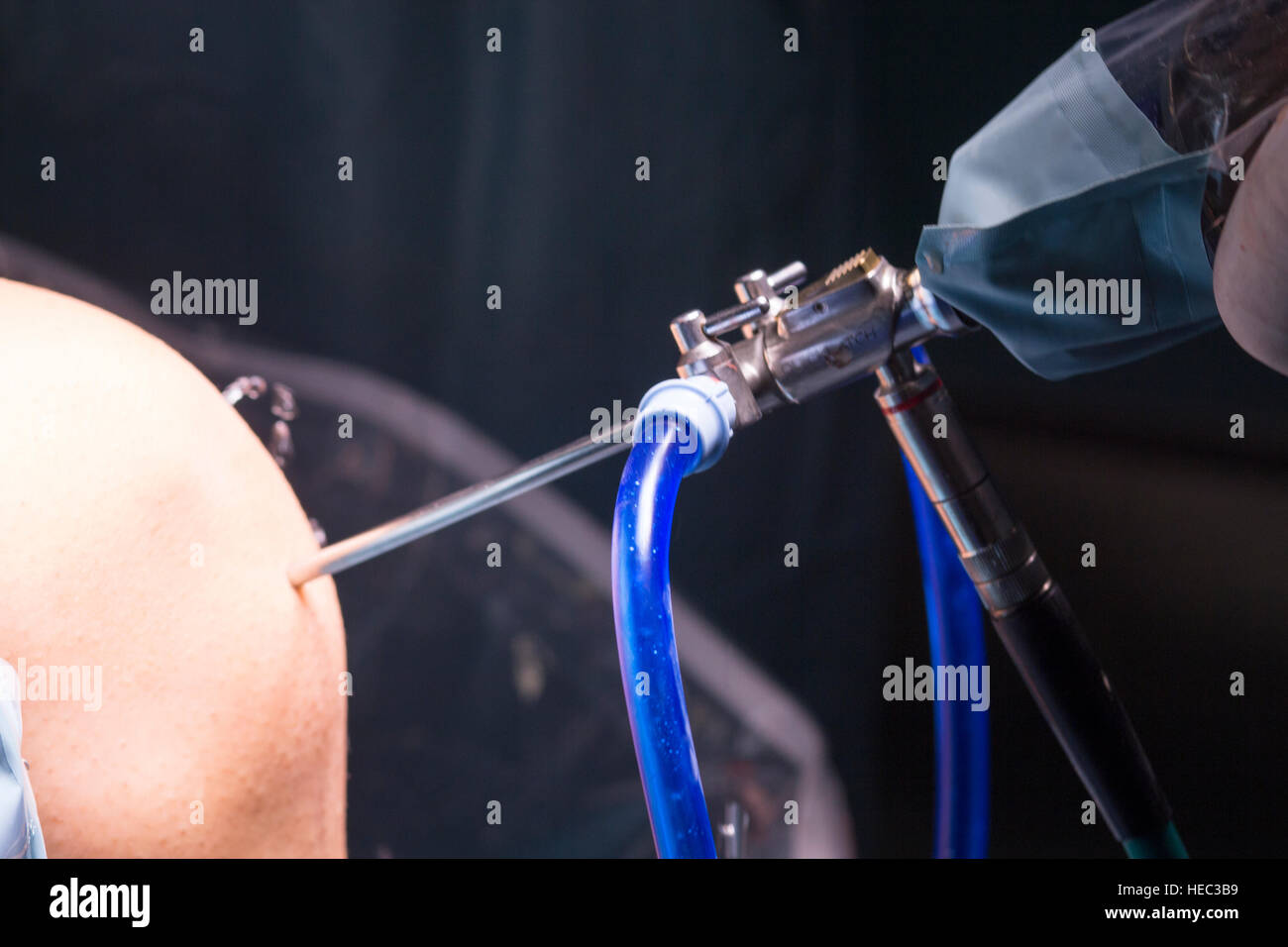 Surgical operation knee arthroscopy micro surgery in hospital operating ...